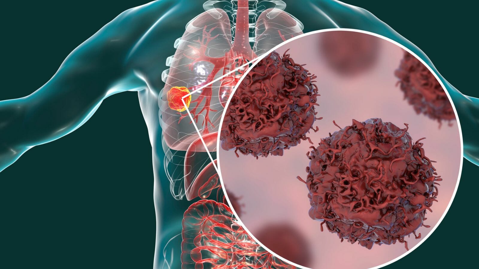 Lung Cancer Guides: Diagnosis, Treatment, And Support Resources