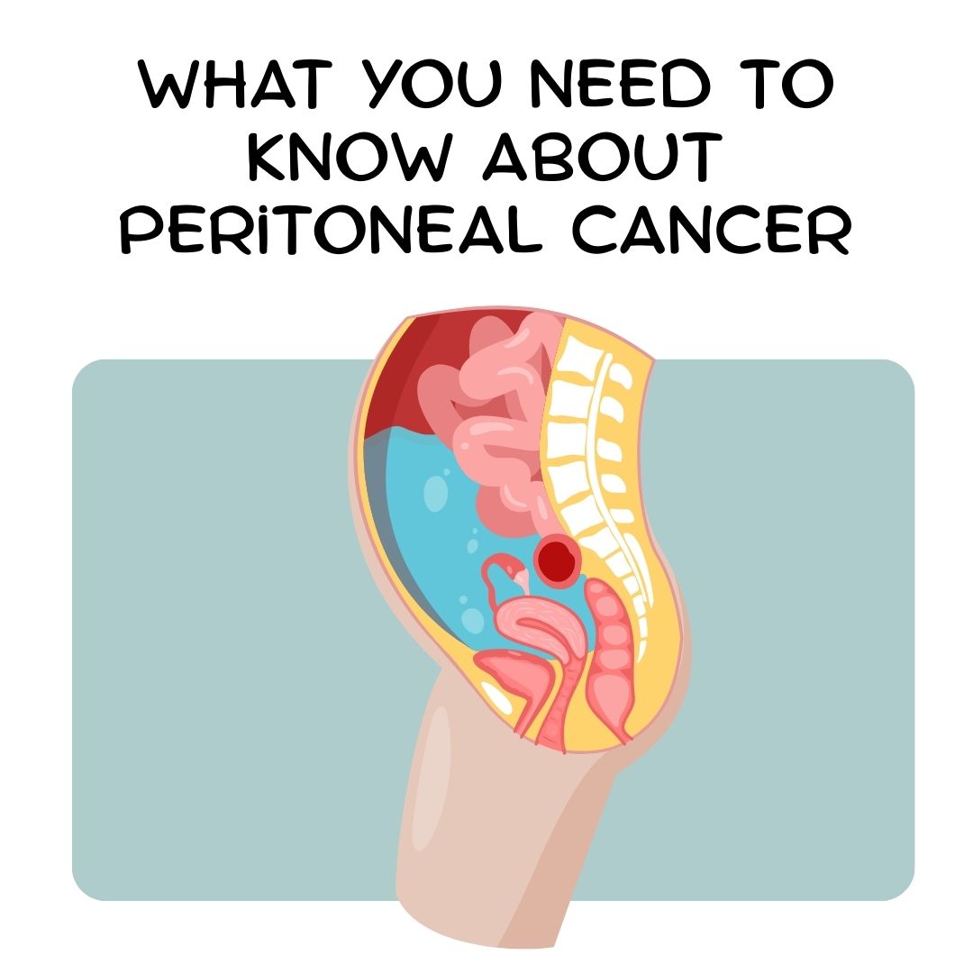 A Guide To Primary Peritoneal Cancer
